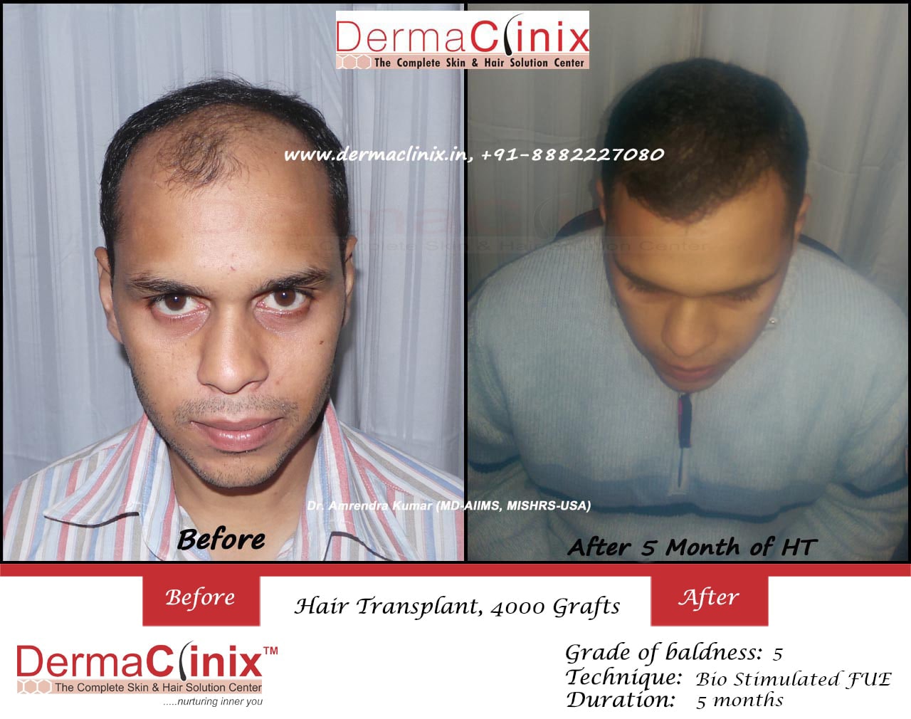 Hair Transplant Results In Chennai Before After Photos Dermaclinix