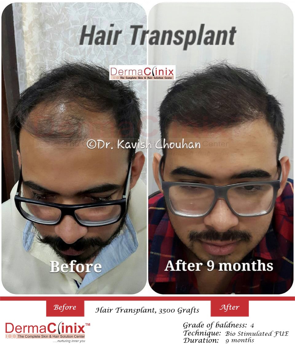 Hair Transplant Results In Chennai Before After Photos Dermaclinix