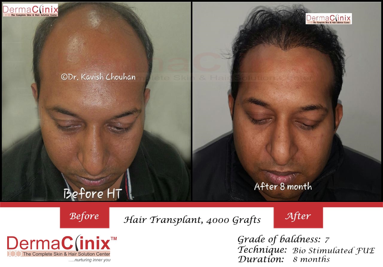 Hair Transplant Results In Chennai Before After Photos Dermaclinix
